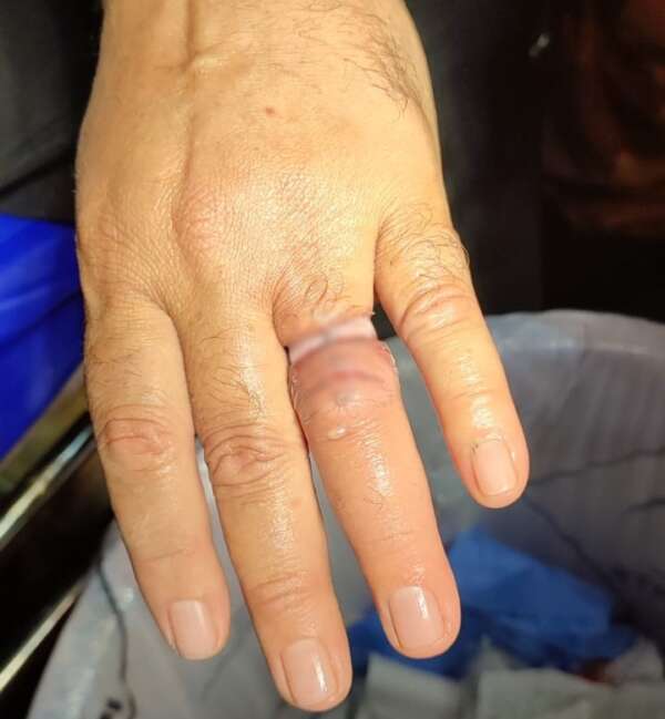 CBMCE realiza retirada de anel que ficou preso em dedo de homem em Fortaleza - Secretaria da ...